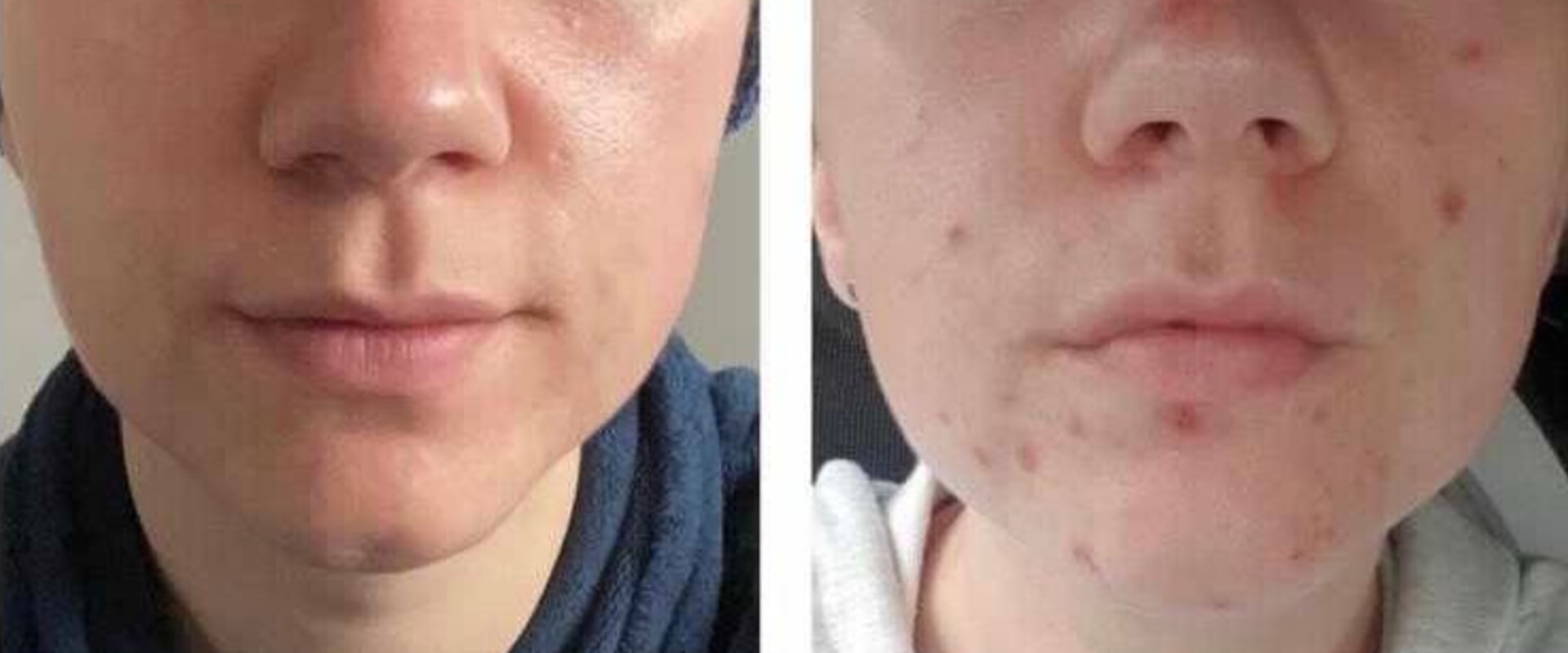 What Chemical Peel is Best for Acne Scars?